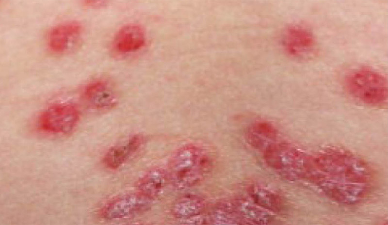 CronicidadHoy | Más allá de las pústulas - Psoriasis Pustulosa ...
