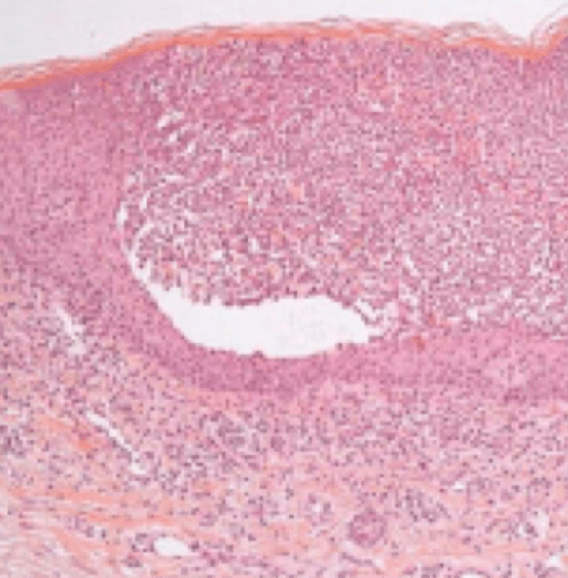 Más allá de las pústulas - ¿Cuánto sabes sobre PPG? | CronicidadHoy