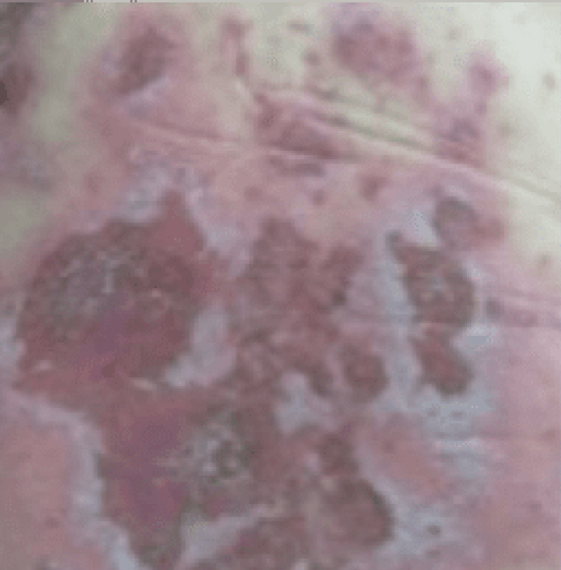 Más allá de las pústulas - ¿Cuánto sabes sobre PPG? | CronicidadHoy