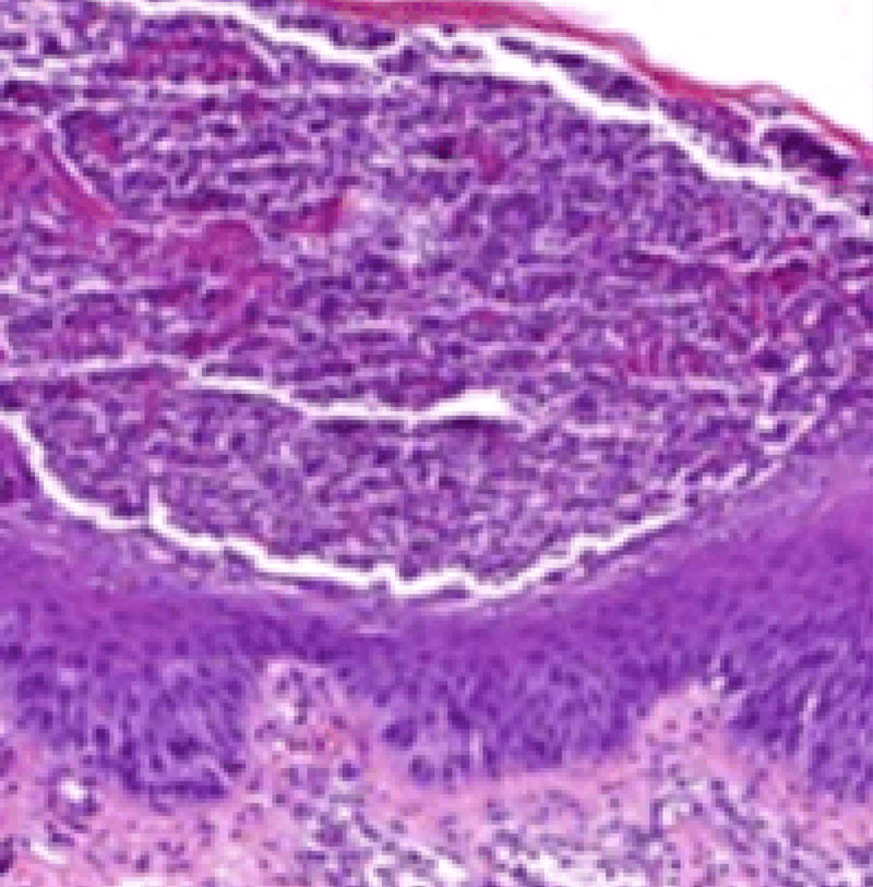 Más allá de las pústulas - ¿Cuánto sabes sobre PPG? | CronicidadHoy