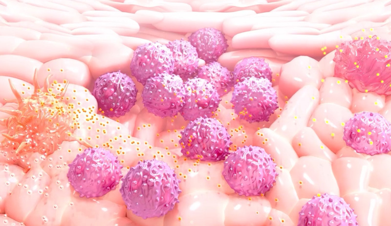 Más allá de las pústulas - Psoriasis Pustulosa Generalizada (PPG ...